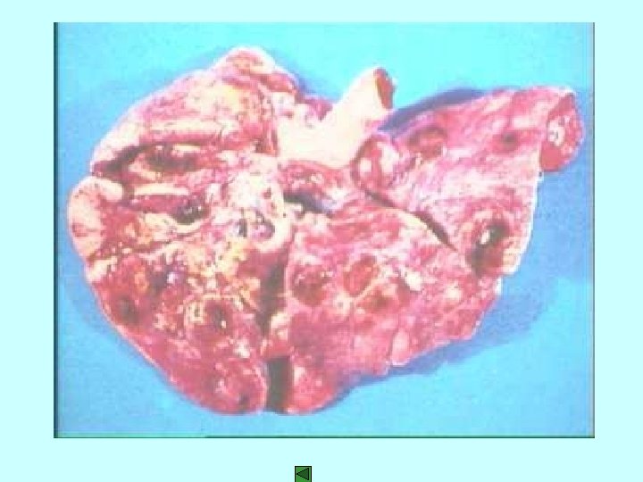 PARAGONIMIASIS Paragonimus westermani lung fluke A miracidium hatching