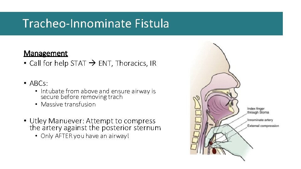 Approach to Tracheostomies Dr Neil Arnstead PGY5 Department
