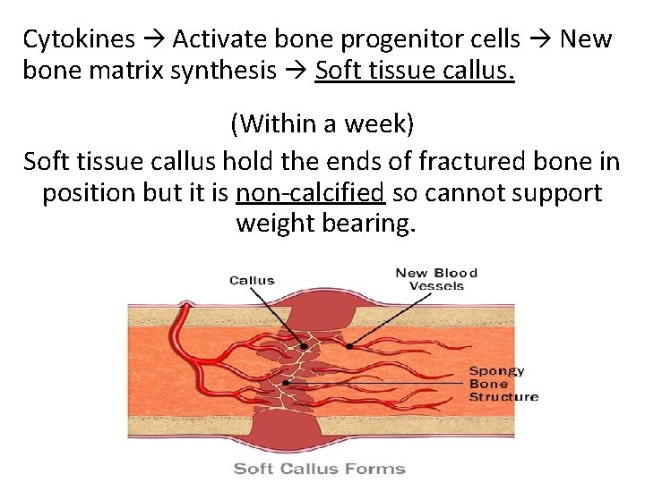 Healing of fractured bone Lecture 3 Dr Nadia