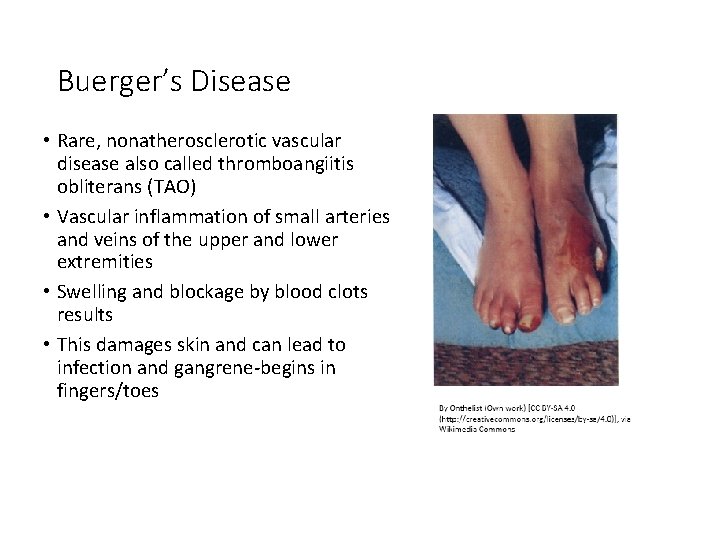 Module 3 Clinical Pathology Neuropathic Disorders Overview Buergers