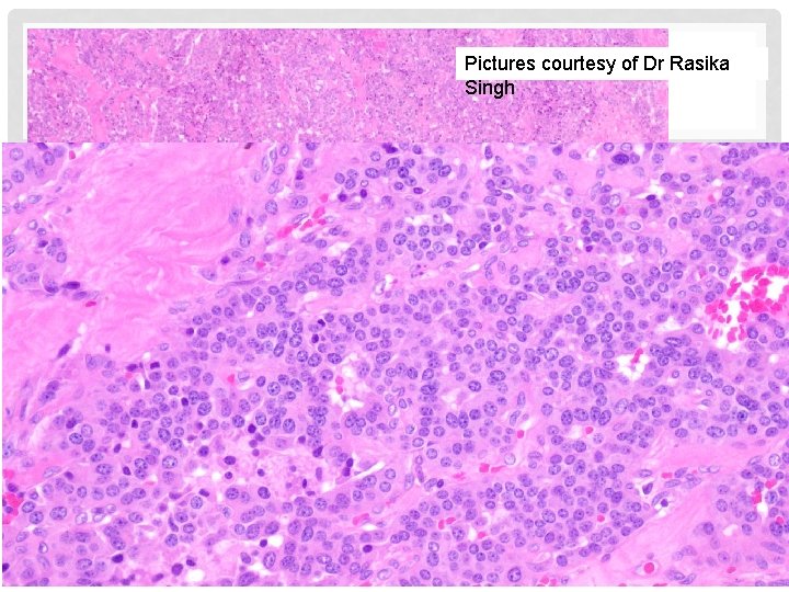 FAMILIAL THYROID CARCINOMA BASED ON DIAGNOSTIC HISTOPATHOLOGY FAMILIAL