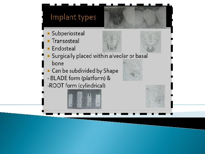 IV Types of bridge prostheses Cantilever bridges Immediate