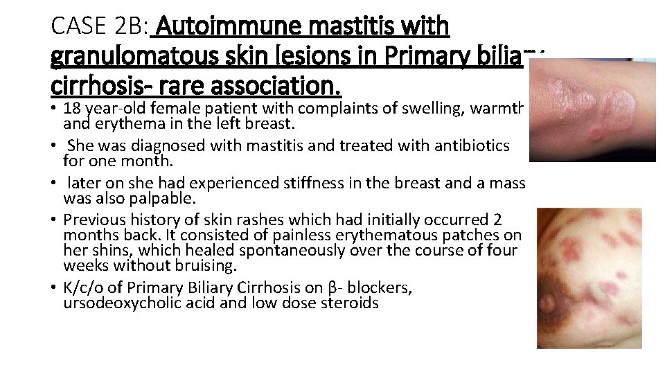 CASE SERIES OF RARE BREAST DISEASES AND THEIR