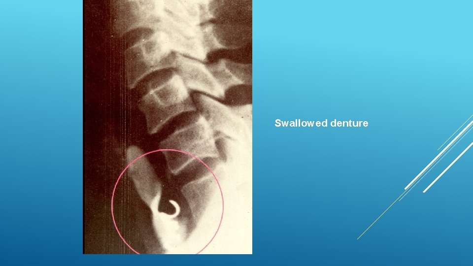 FOREIGN BODY IN GI TRACT Associate Prof Dr
