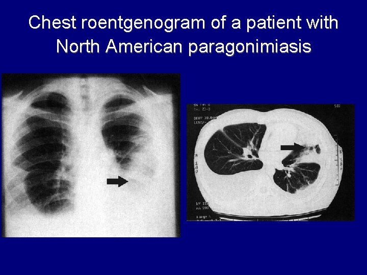 Paragonimus spp Paragonimus westermani Definitive Hosts Paragonimus ...
