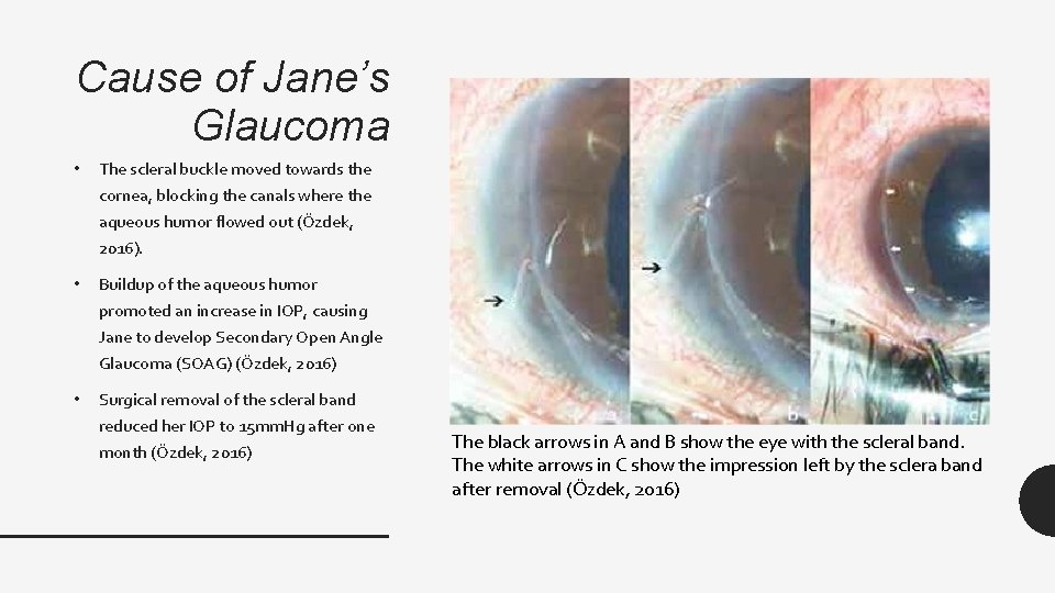 CAUSES AND TREATMENTS FOR THE ONSET OF GLAUCOMA