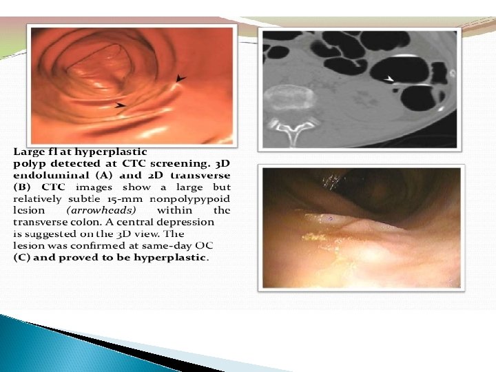 VIRTUAL COLONOSCOPY DR DEEPIKA SOLANKI Medical imaging procedure