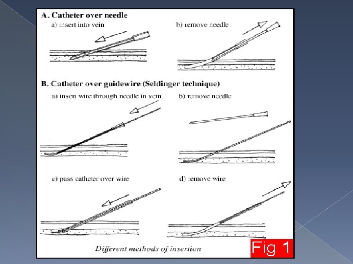 CENTRAL VENOUS CATHETERISATION INDICATIONS Measurement of central venous