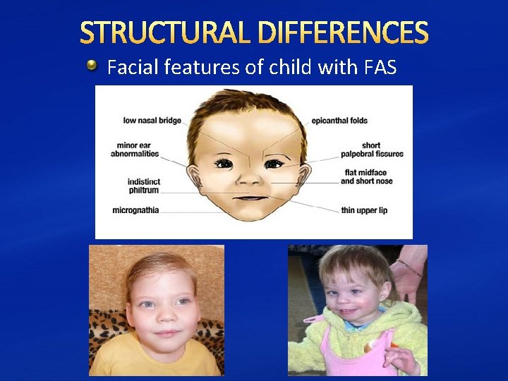 FETAL ALCOHOL SYNDROME Definition of Fetal Alcohol Syndrome