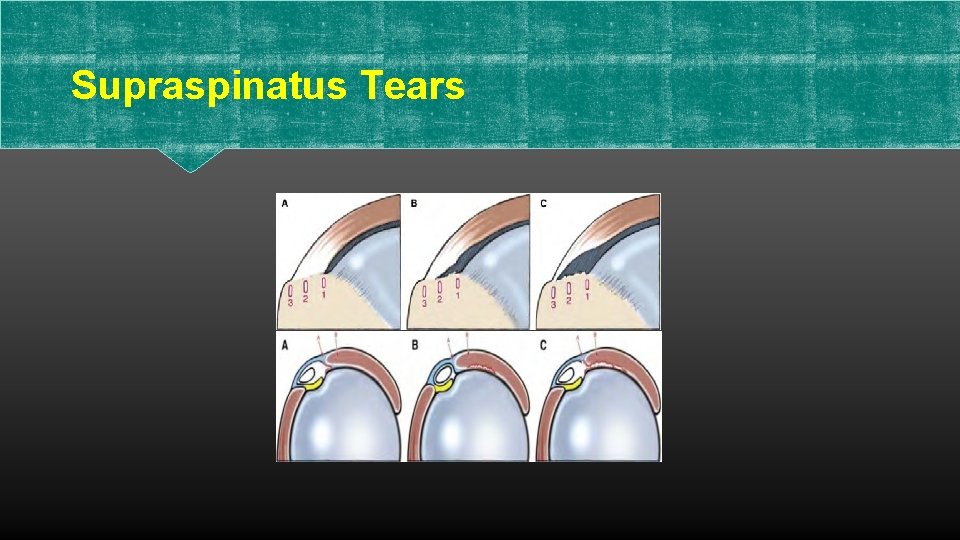 Ultrasound Evaluation of Shoulder Pathology November 2020 Copenhagen