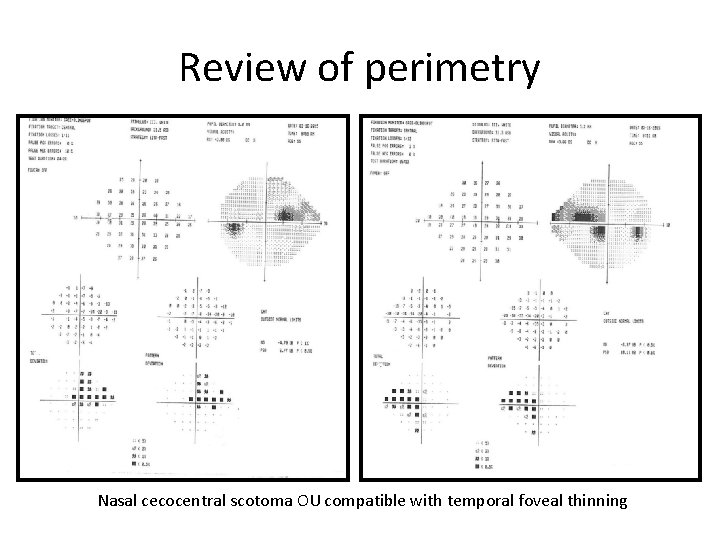 Grand Rounds Retinal vascular disease with unique findings
