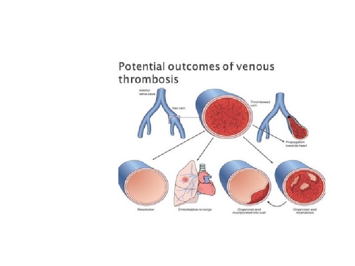Thrombosis and embolism Thrombosis Gangrene Infarction Embolism Thrombosis