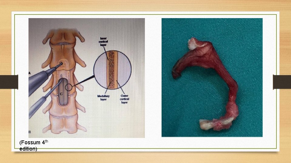 CONGENITAL SPINAL DERMOID SINUS IN DSH PRESENTED BY