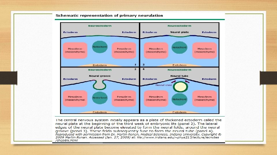 CONGENITAL SPINAL DERMOID SINUS IN DSH PRESENTED BY