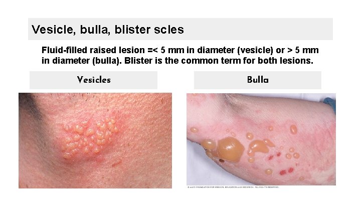 Acute Inflammatory Dermatoses Ghadeer Hayel M D Histopathologist