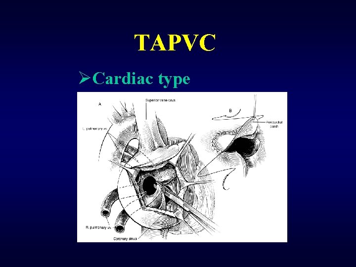 Total Anomalous Pulmonary Venous Connection Seoul National University