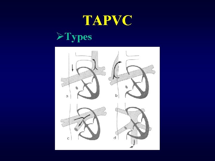 Total Anomalous Pulmonary Venous Connection Seoul National University