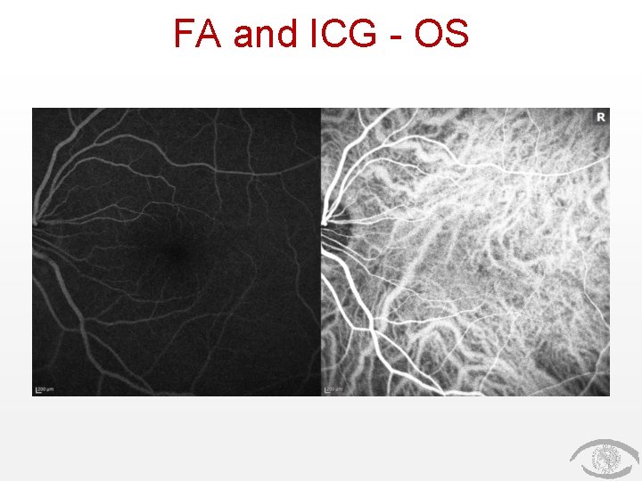 Grand Rounds A Case of Unilateral Subretinal Fluid
