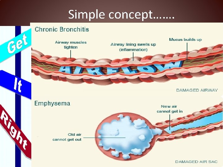 CHRONIC OBSTRUCTIVE PULMONARY DISEASE CHRONIC OBSTRUCTIVE LUNG DISEASES
