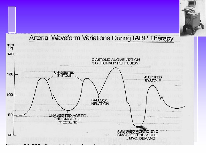 INTRA AORTIC BALLON COUNTERPULSATION PHYSIOLOGY INDICATIONS REVIEW IABP