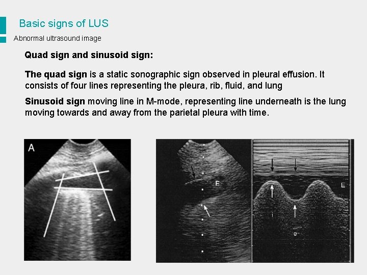 Lung Ultrasound Content 1 Basic Principle of LUS