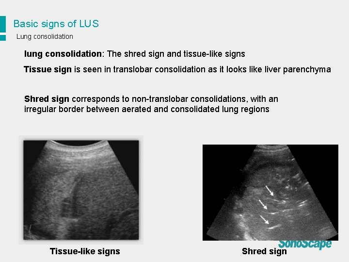 Lung Ultrasound Content 1 Basic Principle of LUS