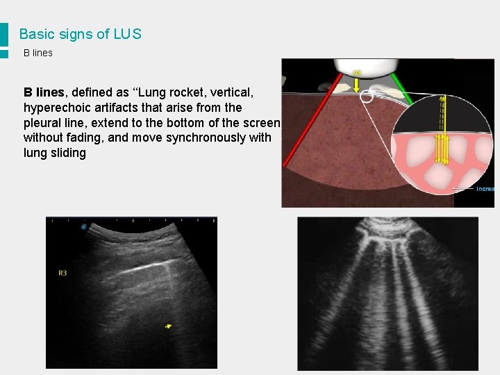 Lung Ultrasound Content 1 Basic Principle of LUS