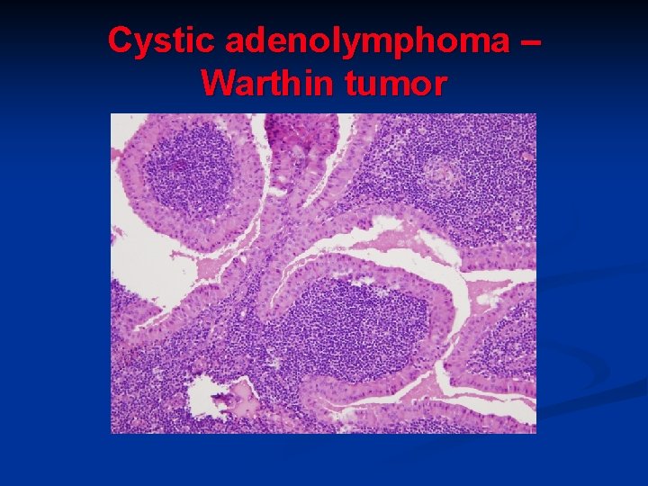 Salivary gland pathology Markta Hermanov Parotid gland serous