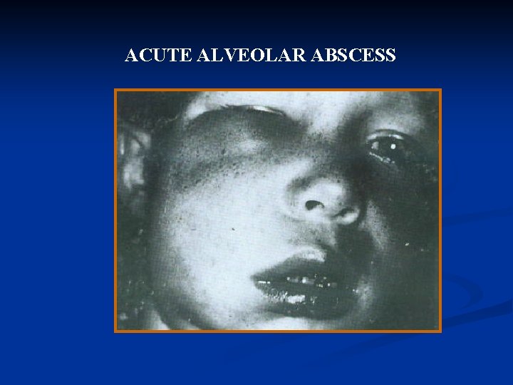 Diseases of the Periradicular Tissues 1 Acute alveolar