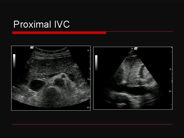 Sonographic Assessment of the Inferior Vena Cava Alexis