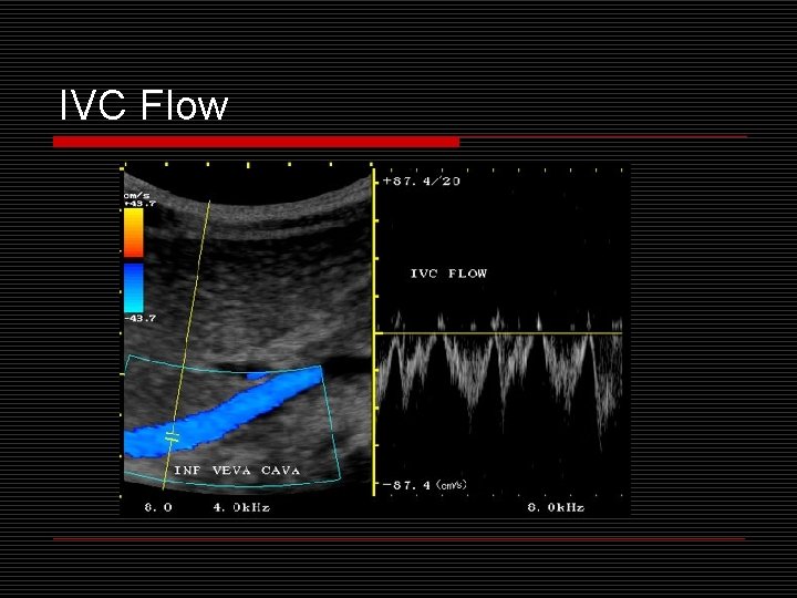Sonographic Assessment of the Inferior Vena Cava Alexis