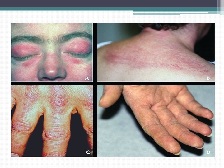 Polymyositis and dermatomyositis BY Dr Eman Ragab DEFINITION