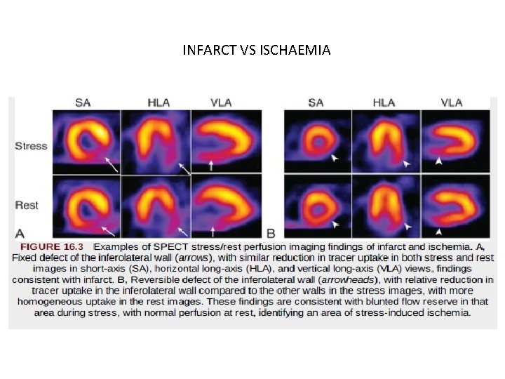 Basics of Cardiac Nuclear Imaging v Dr Amol