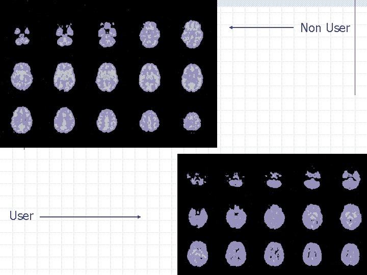The Effects of Drug Use Ecstasy BBC News