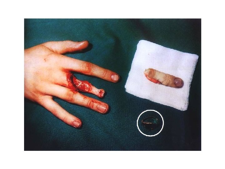 Soft Tissue Injuries Abrasion Scrape no active bleeding