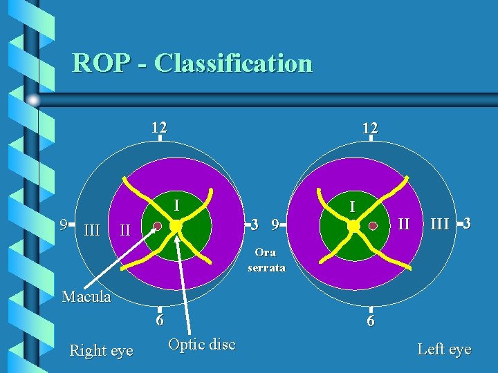 Retinopathy Of Prematurity Dr Sarah farshadfar ROP Definition