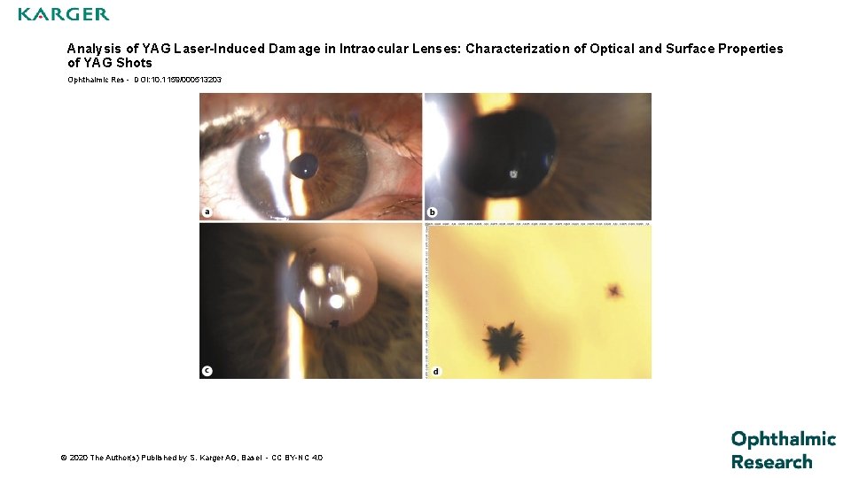 Analysis of YAG LaserInduced Damage in Intraocular Lenses