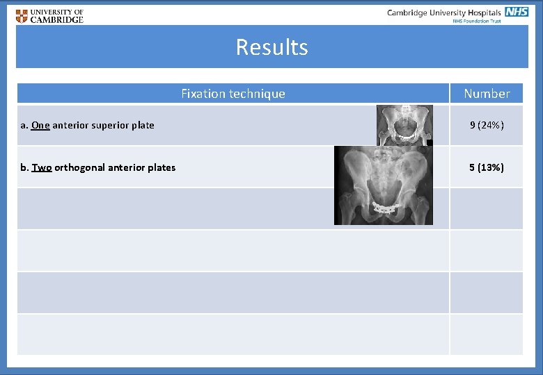 Cambridge Orthopaedic Club Fixation of APC II Tile