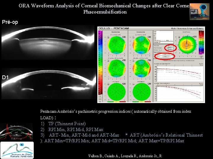 ORA Waveform Analysis of Corneal Biomechanical Changes after