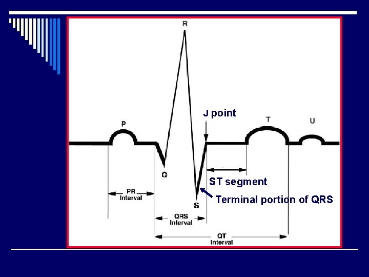 Diagnosis of Myocardial InfarctionIschemia with Bundle Branch Blocks