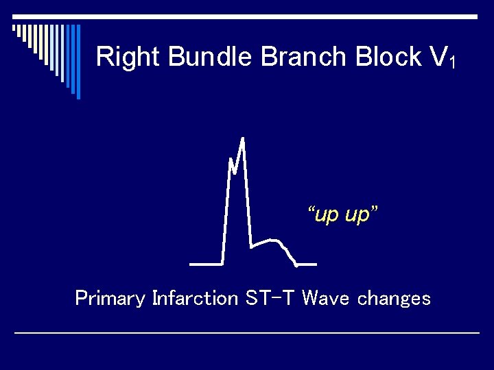 Diagnosis of Myocardial InfarctionIschemia with Bundle Branch Blocks