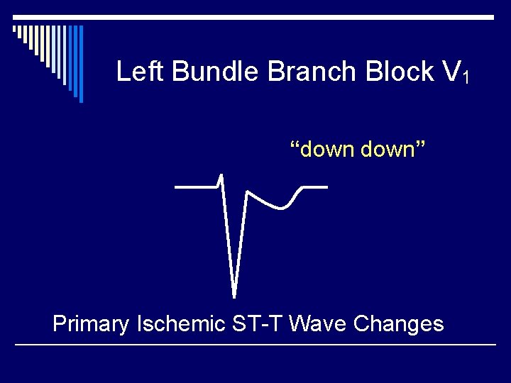 Diagnosis of Myocardial InfarctionIschemia with Bundle Branch Blocks