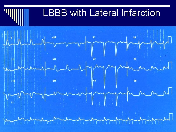 Diagnosis of Myocardial InfarctionIschemia with Bundle Branch Blocks