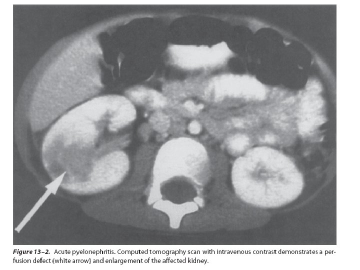 Pyelonephritis 1 Contents Definition Types Etiology Clinical features