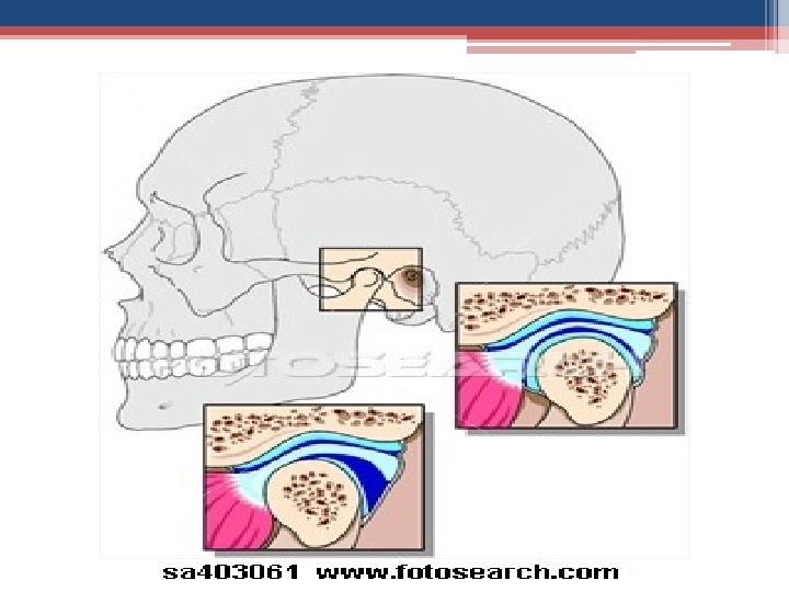 TEMPOROMANDIBULAR DISLOCATION BY DR MANISHA MISHRA TMJ The