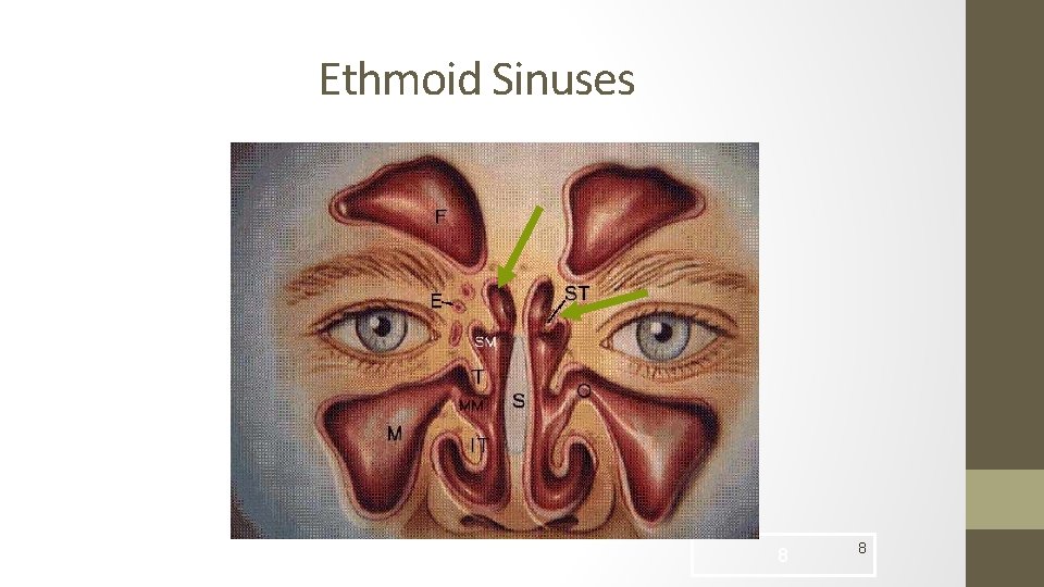 Acute Rhinosinusitis ARS Presented by Mohammad AlRamadneh Terminology