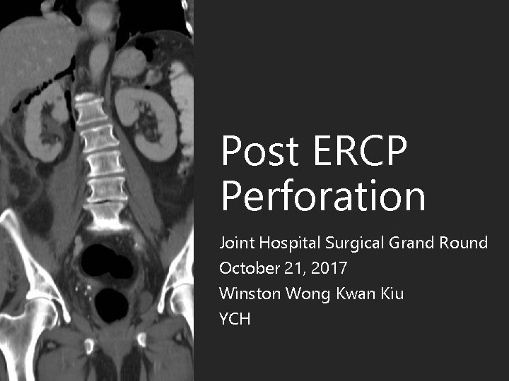 Post ERCP Perforation Joint Hospital Surgical Grand Round