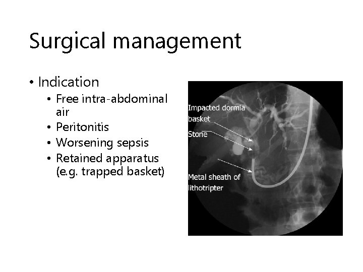 Post ERCP Perforation Joint Hospital Surgical Grand Round