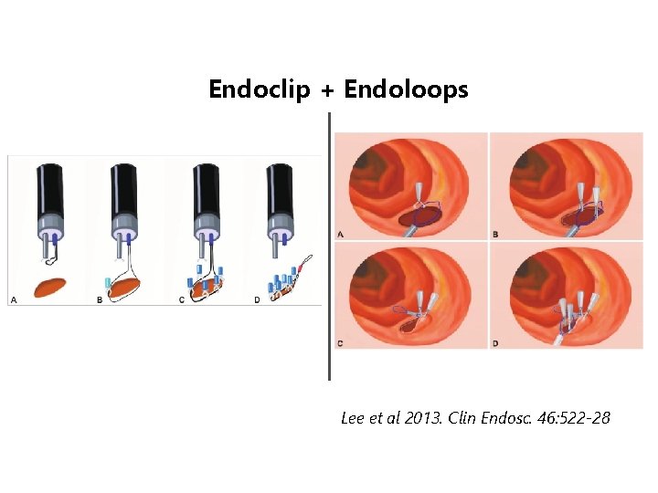 Post ERCP Perforation Joint Hospital Surgical Grand Round