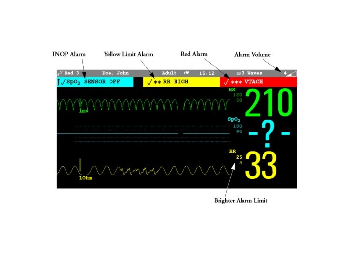 Alarm Safety in the NICU Purpose of Clinical